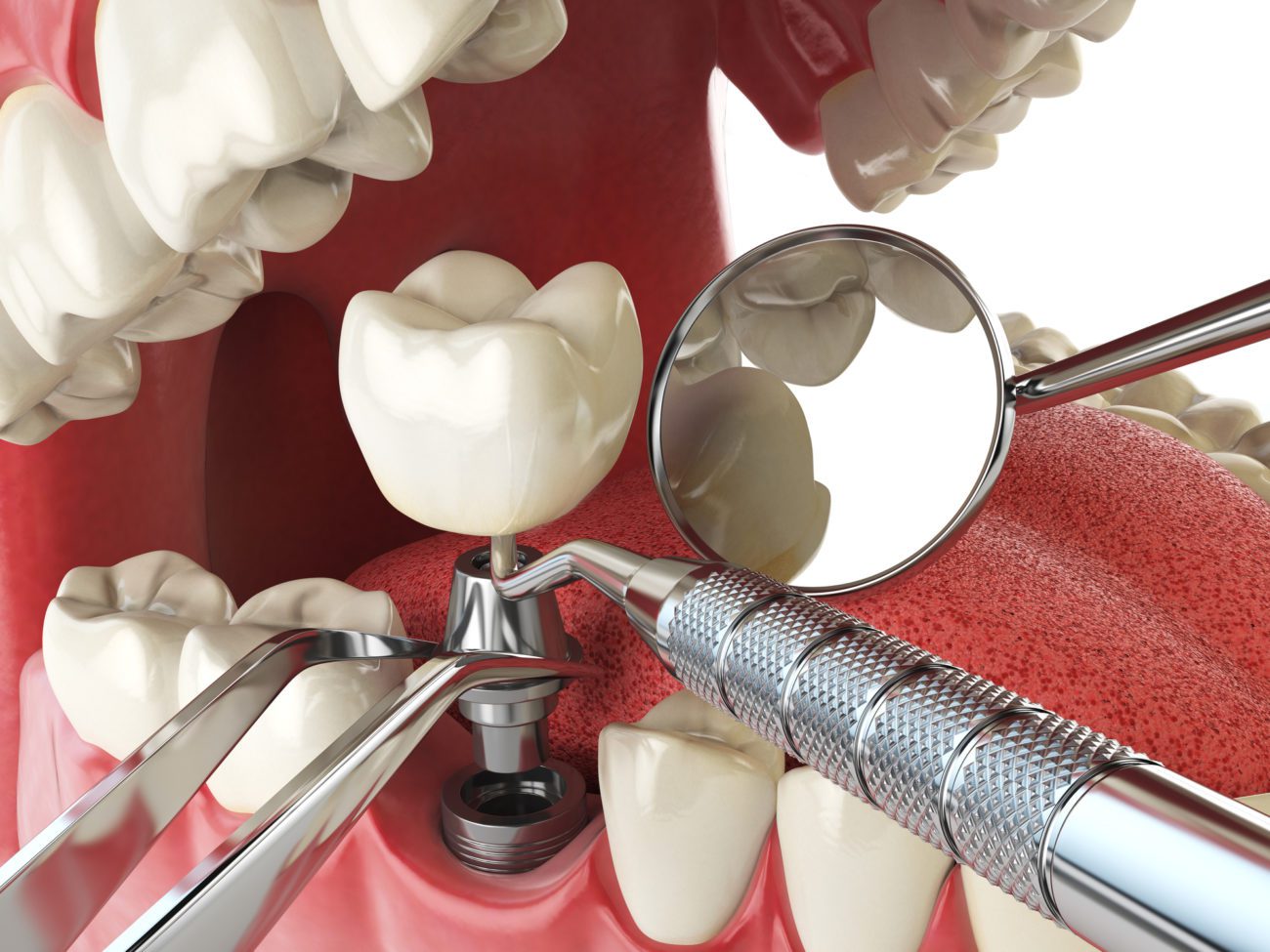 Dental Implants Yardley PA | Single Tooth Implant Newtown