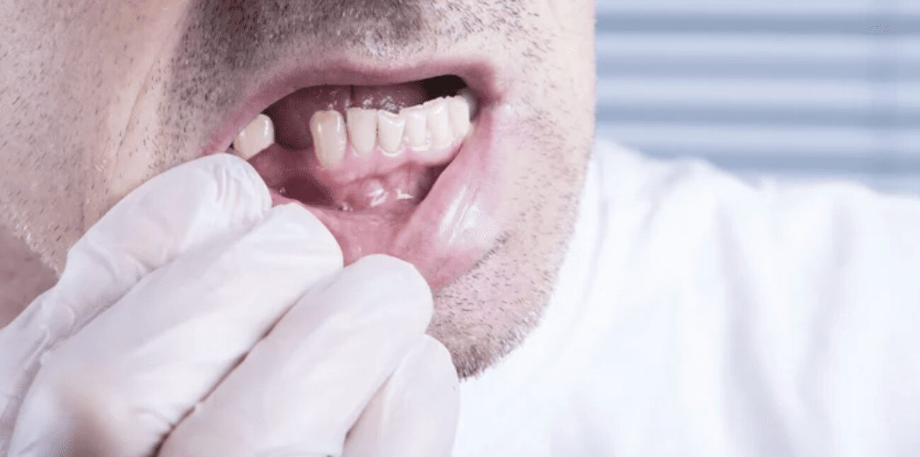 Gum Disease and Tooth Loss - Dentist in Yardley, PA